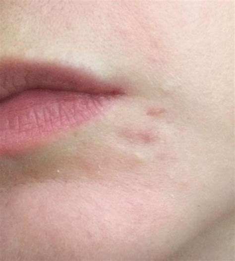 Cortisone Shot Kenalog Injection Before And After Pics Personal Logs Forum