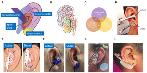 Auricular Vagus Neuromodulation—a Systematic Review On Quality Of