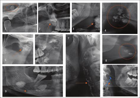 Soft Tissue Calcifications Observed 1 Superficial Temporal Artery Download Scientific Diagram