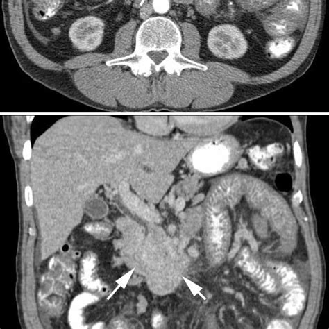 Preoperative Abdominal Ct Scan Demonstrating Large Mesenteric Soft