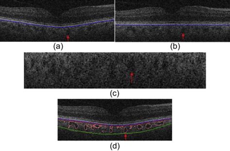Standard OCT Scans Showing Choroidal Vasculature A OCT Volume With Download Scientific