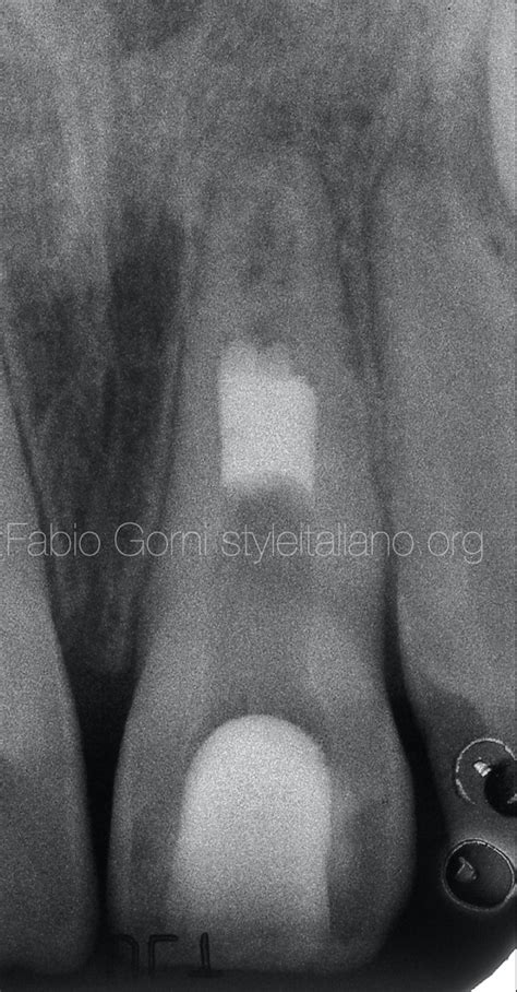 Revascularization 6 Years Follow Up Style Italiano Endodontics