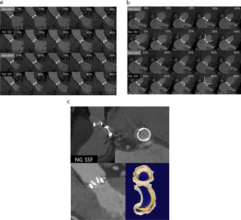 A Whole Heart Motion Correction Algorithm Effects On Ct Image Quality