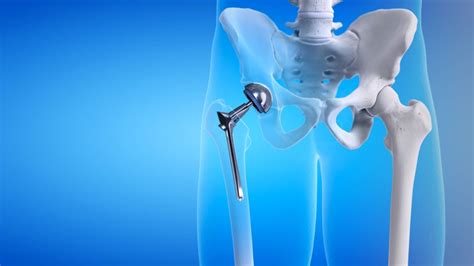 جراحی تعویض مفصل لگن دکترمهرآیین
