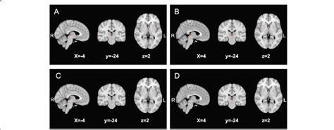 Altered Habenula Sn Functional Connectivity Maps Altered Resting State