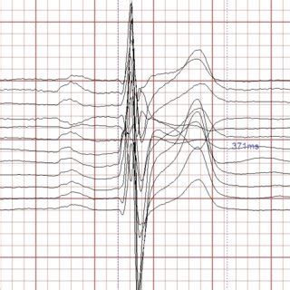 Method Of Measurement Of The QT Interval Used Download Scientific Diagram