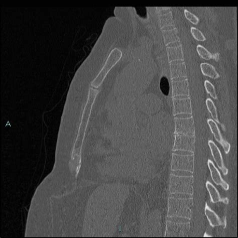 12 Best Xiphoid Process Images Xiphoid Process All