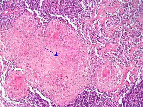 Histopathology Mesenteric Lymph Nodes