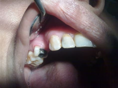 Dr Mohammed Arnous Class Iii Composite Restoration Dr Mohammed Arnous Class Iii Composite Restoration