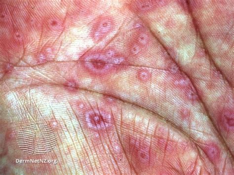 Erythema Multiforme Almostadoctor