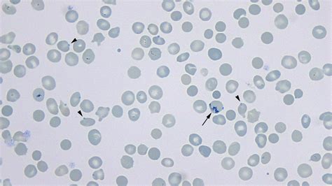 Aggregate Reticulocyte Archives Eclinpath