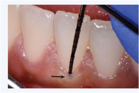 Mucogingival Deformities And Conditions Around Teeth Quiz 2