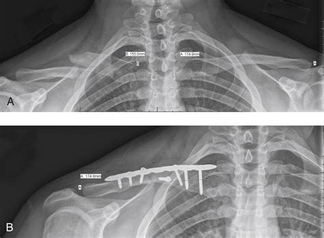 Open Reduction And Internal Fixation Of Clavicle Fractures Musculoskeletal Key