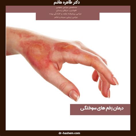 درمان زخم های سوختگی بهترین پماد سوختگی