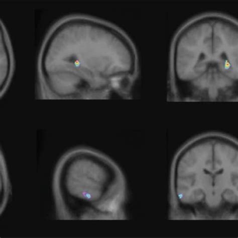 Statistical Parametric Maps Spm8 Wellcome Functional Imaging