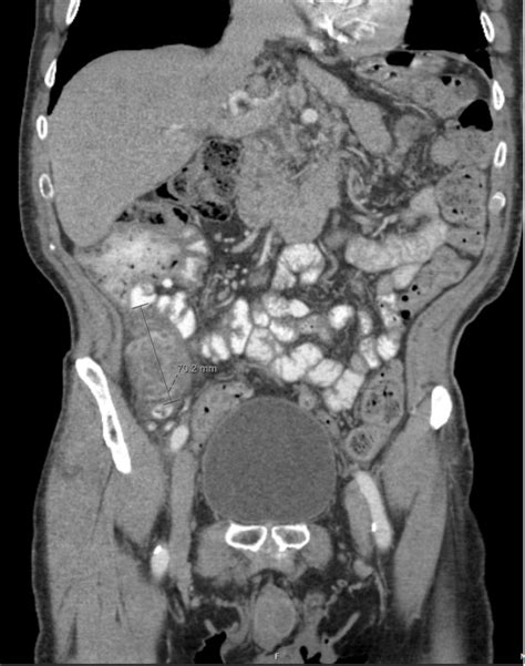 Imaging Findings Of Small Bowel Diverticulitis A Case Report Jetem