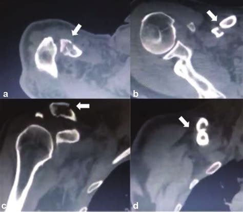 Computed Tomography Scan Of Robinson Type 2b2 Segmental Fracture A