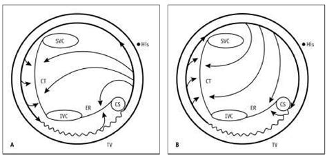 Reentrant Circuit In Typical Counterclockwise A And