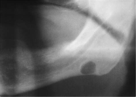 Nonodontogenic Jaw Cysts Stafne Bone Cyst