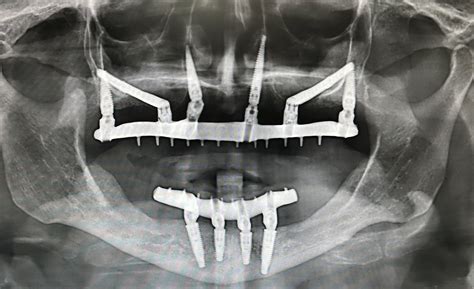 Zygomatic Implants Cdic Zygoma Dental Implant Surgery