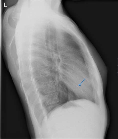 Subdermal Contraceptive Implant Migration To Pulmonary Artery Branch Pmc