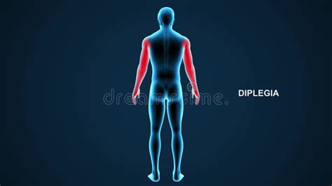 Diplegia Type Paralysis 3d Rendered Video Clip Stock Video Video Of