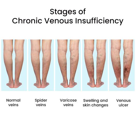 Venous Insufficiency Treatments In Brooklyn New York Vascular Specialist