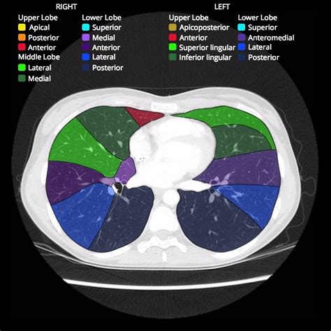 Bronchopulmonary Segments Annotated Ct Radiology Case Radiopaedia