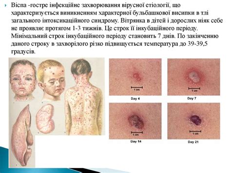 Дитячі інфекційні хвороби Online Presentation