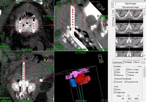 radcalc qa software verifies non standard treatment plans for hdr