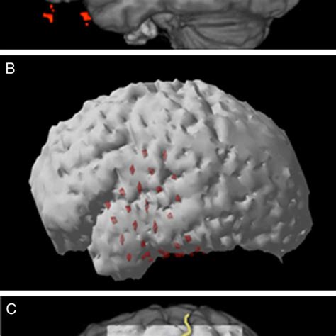 3d Reconstruction And Correlation In Area 4 Patient 3 A Presurgical Download Scientific