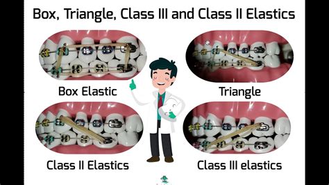Class 2 Elastics Side Effects At Benjamin Hutchison Blog