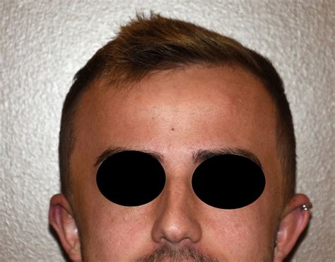 Young Male Temporal Reduction Front 2 Dr Barry Eppley Explore Plastic Surgery