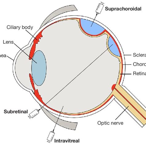 A Schematic Diagram Illustrating 3 Different Intraocular Injection