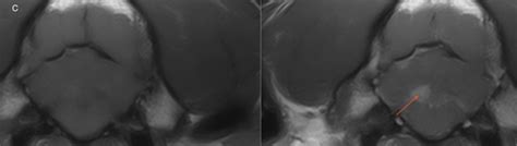 Metastatic Intracranial Choroid Plexus Tumours Hallmarq Veterinary Imaging