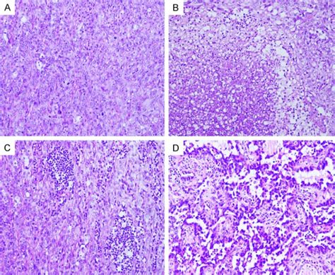 Lymphangiosarcoma Of The Jejunum In A 44 Year Old Man Report Of A Case