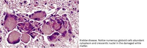 Path Sdl 13 Metabolic Diseases Of The Nervous System Test 2