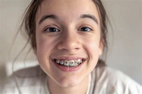Difference Between Fixed Braces And Removable Braces In Riyadh Jeddah Saudi Arabia