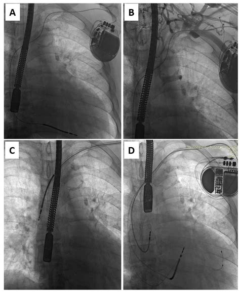 Efficacy And Safety Of Transvenous Lead Extraction At The Time Of