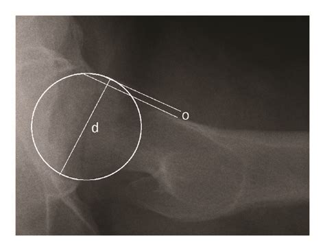 The Offset Ratio Was Measured As The Ratio Between The Anterior Offset Download Scientific