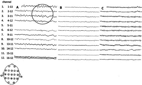 Figure3 Time Course Of Electroencephalography Eeg Mono Polar 1 Eeg