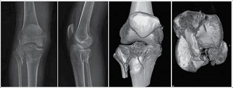 Functional Outcome Of Proximal Tibia Fractures Shatzkers Type V And Vi Fixed With Open