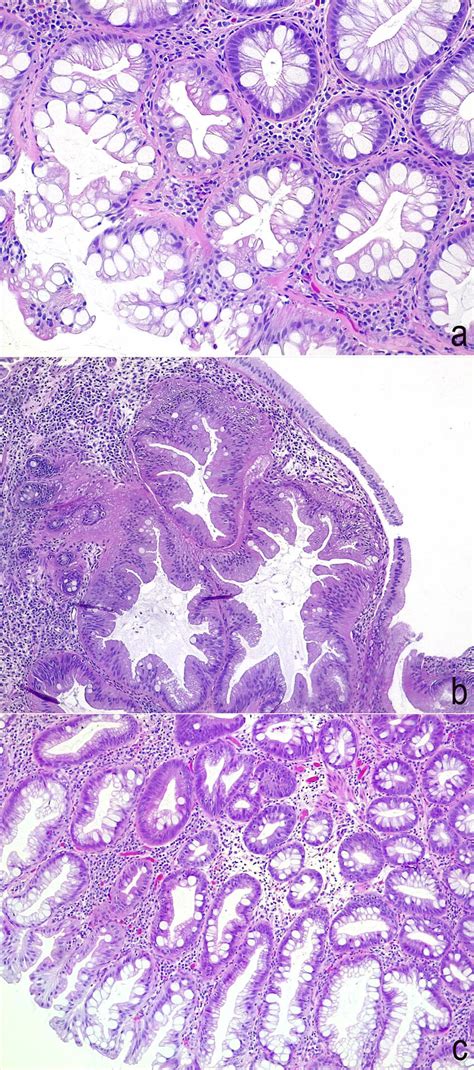 Histopathologic Features Of Serrated Lesions A Goblet Cell Rich Download Scientific Diagram
