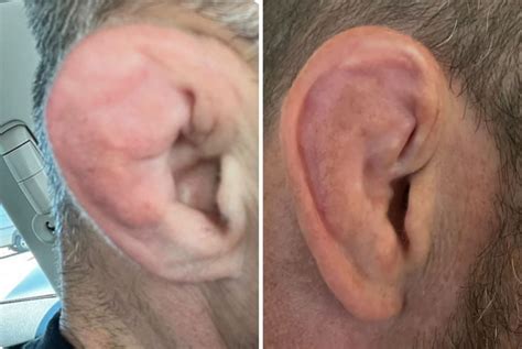 Cauliflower Definition Ear At Laurence Drake Blog