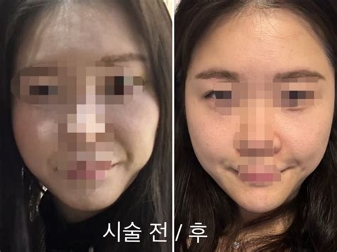 더블로골드 올리지오 피부리프팅 함께 받은 후기가격 통증 네이버 블로그