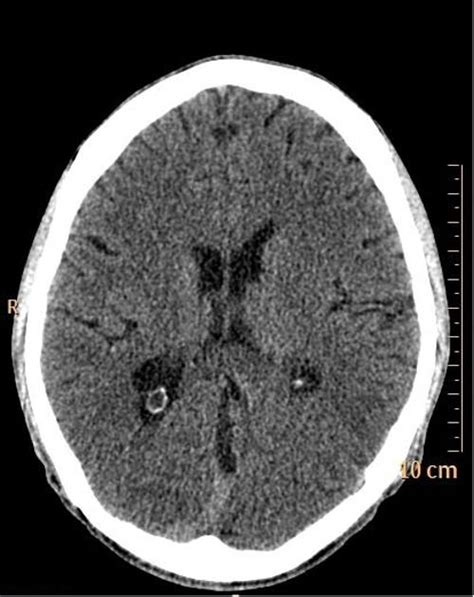 Plexus Choroideus Schafgehirn
