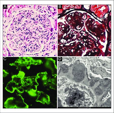 A Glomerulus With Membranoproliferative Pattern Accentuation Of The Download Scientific