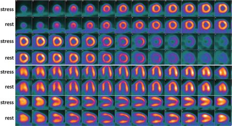 4 Rest And Regadenoson Stress Myocardial Perfusion Images Obtained With Download Scientific