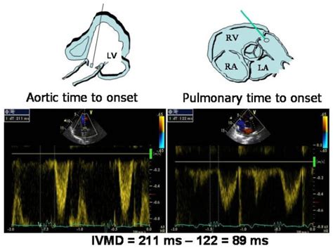 Concepts Of Cardiac Dyssynchrony And Dynamic Approach Pmc