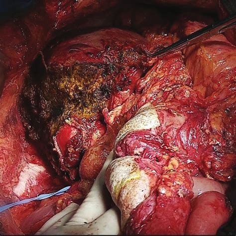 Completion Of Extended Right Hepatectomy Download Scientific Diagram